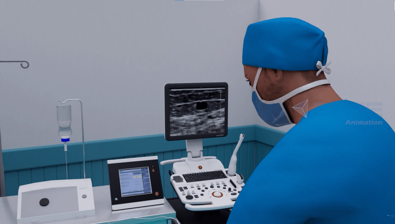 Endovenous Laser Ablation Treatment Animation Services