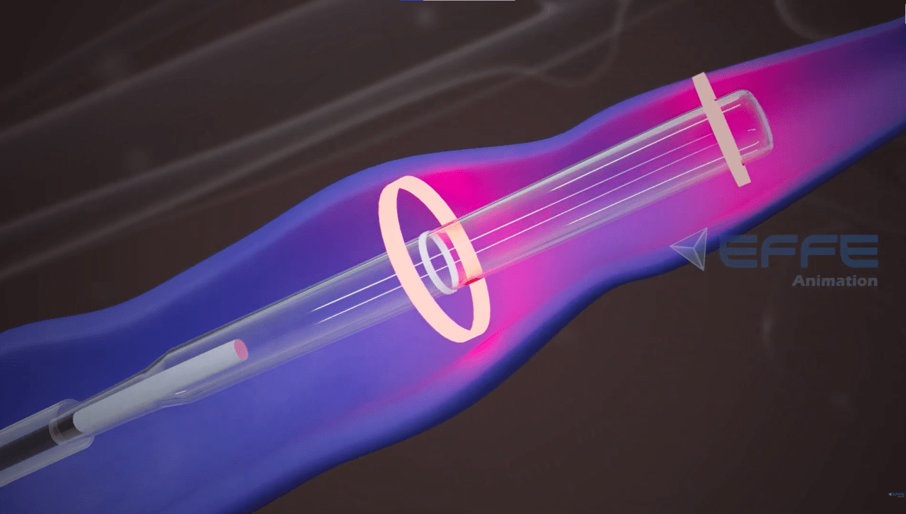Endovenous Laser Ablation Treatment Animation Services