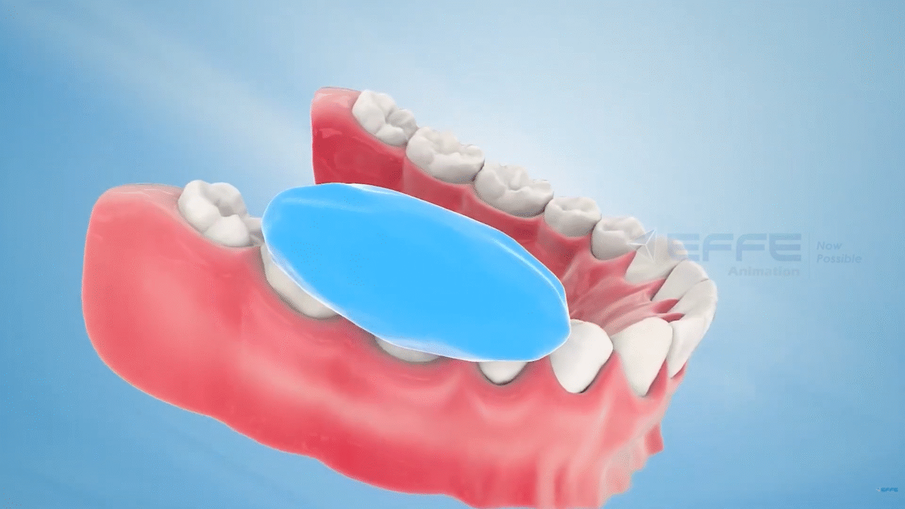 Dental Application Animation Services | 3D Dental Videos