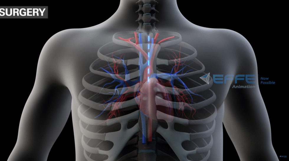 Cardiovascular Surgery Animation Services | 3D Bypass
