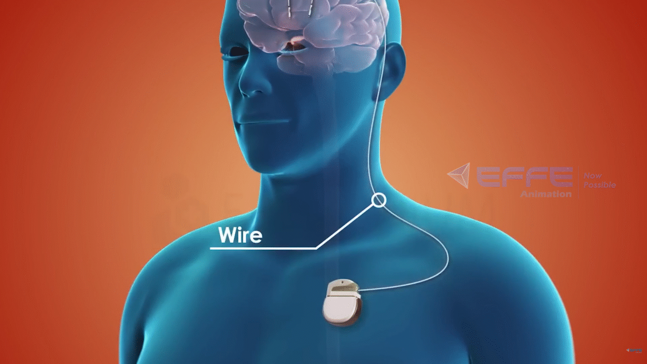 Surgical Device Animation Company | 3D DBS Visuals