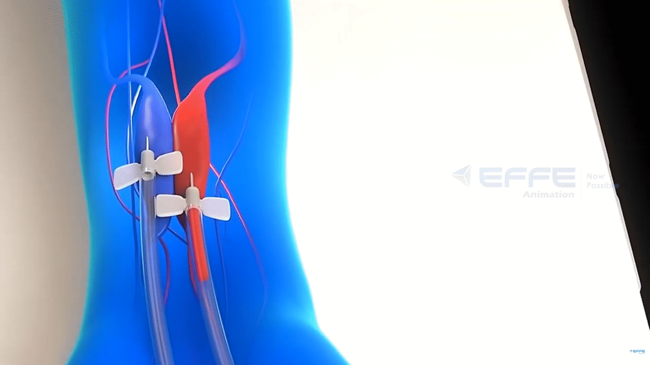 Renal Devices Animation Company | 3D Hemodialysis Visuals